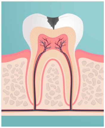 Tooth decay and fillings - Dentiste St-Lambert - Concept Dentaire Rive-Sud